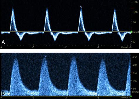 A Doppler Ultrasound Of A Healthy Femoral Artery In A 67 Yearold