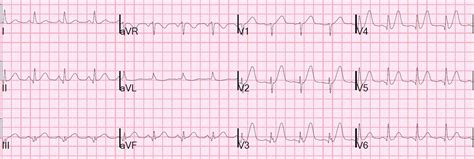 Hyperacute T Waves With A Twist Dr Smiths Ecg Blog