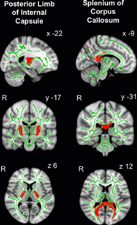 Posterior Limb Of Internal Capsule And Splenium Of Corpus Callosum Download Scientific Diagram