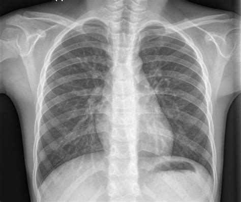 Airespucrs Chest Xray · Datasets At Hugging Face