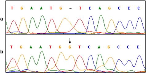 Sequence Analysis Of The Androgen Receptor Gene Mutation Dna Sequence