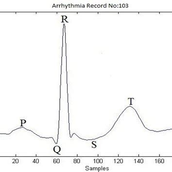 ECG R Peak Detection Download Scientific Diagram