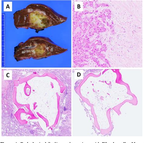 [pdf] Bilateral Diffuse Nodular Pulmonary Ossification Mimicking Metastatic Disease In A Patient