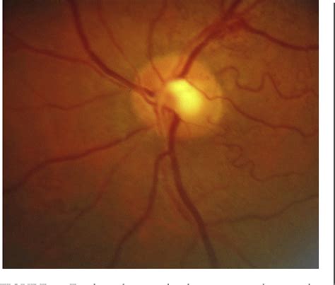 Congenital Ectopic Pupil Semantic Scholar