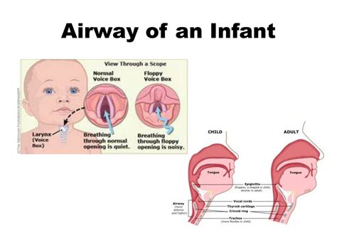 Pediatric Airway At Debra Baughman Blog