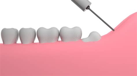 Removing Teeth Stock Illustrations 211 Removing Teeth Stock