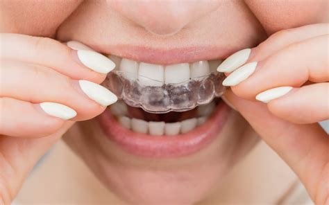 Can Clear Aligners Fix An Overbite
