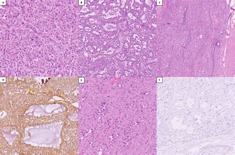 Fumarate Hydratase Fh Deficient Renal Cell Carcinoma Rcc With Low