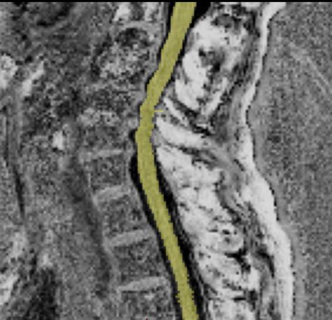 stitching and segmentation sct