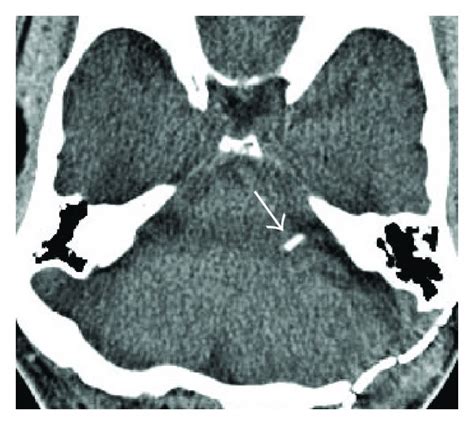 Neurovascular Compression In A Patient Presenting With Left Hemifacial