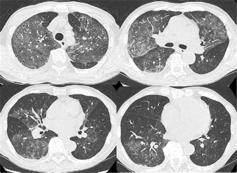 high resolution computed tomography of the chest showed diffuse
