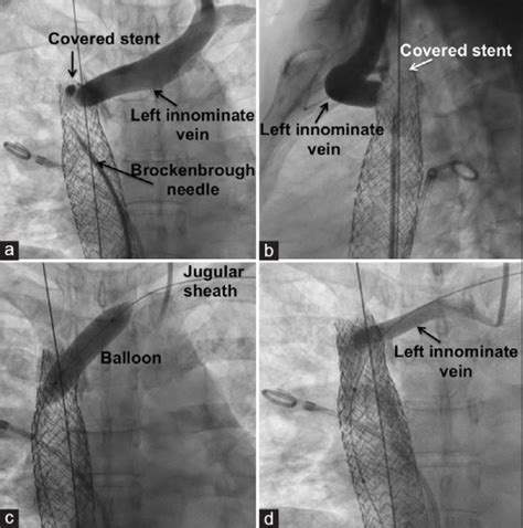 Innominate Vein Occlusion By The Fabric Of Covered Stent During