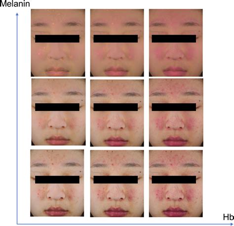 Deep Learning Based Optical Approach For Skin Analysis Of Melanin And