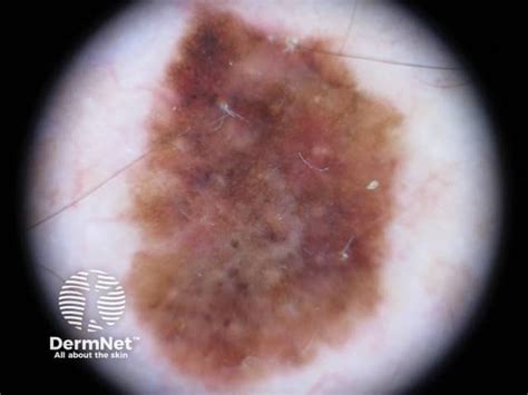 Melanoma In Situ Images