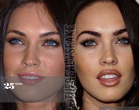 Megan Fox Lip Injections