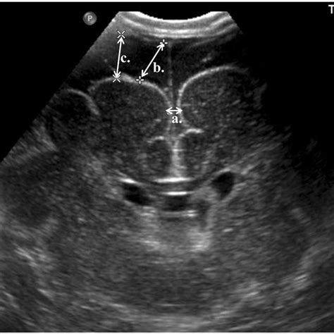 Pdf Enlarged Subarachnoid Space On Cranial Ultrasound In Preterm
