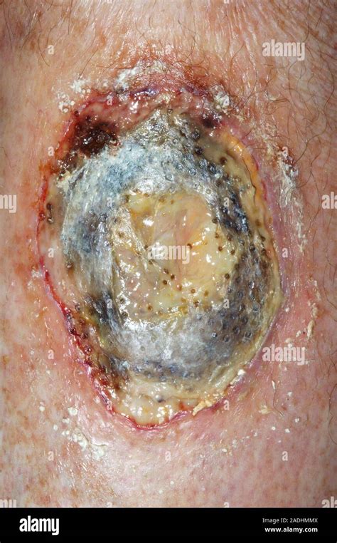 Pyoderma Ulcer On The Skin Of A 60 Year Old Diabetic Man This Is Pyoderma Gangrenosum A Pus