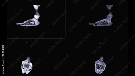 Mri Foot Compare Sagittal And Axial T2 T1 For Diagnostic Tendon Injury