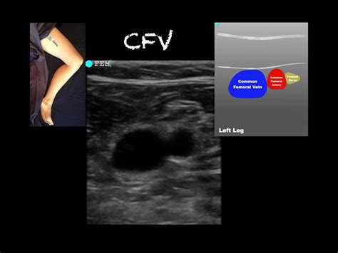 Popliteal Vein Ultrasound