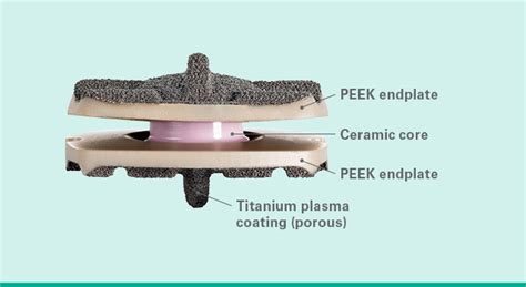 Simplify Disc Nuvasive