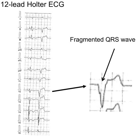 Which Number Of Morphological Types Of Ventricular Premature Beats