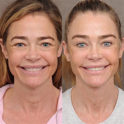 Denise Richards Unfiltered Facelift Before And Afters Are A T To Us All