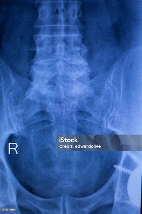 척추 척추뼈 등근육 부상 X선 검사 건강 진단에 대한 스톡 사진 및 기타 이미지 건강 진단 건강관리와 의술 과학 Istock