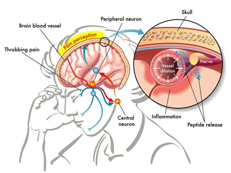 Chronic Migraines And Headaches Symptoms And Treatments