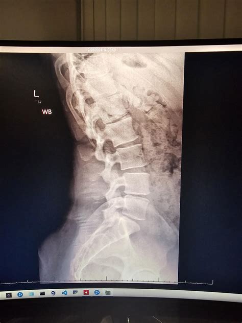 I Hate This Pain Rspondylolisthesis