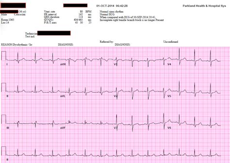 Ekg Practice Strips Printable