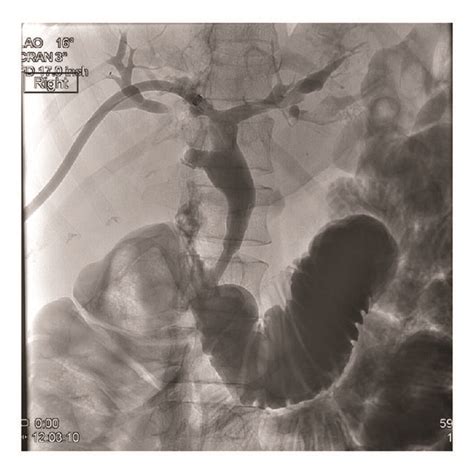 Percutaneous Cholangiogram Showing Biliary Tree After The Procedure Download Scientific Diagram