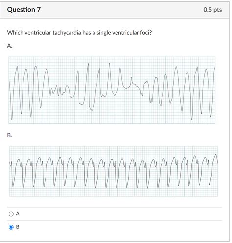 Solved Which Ventricular Tachycardia Has A Single