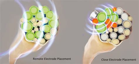 Neurostimulation For Postsurgical Analgesia A Novel System Enabling Ultrasound Guided
