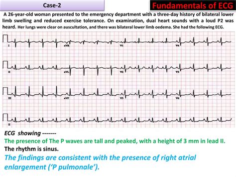 P Wave Abnormalities In Ecg Ppsx