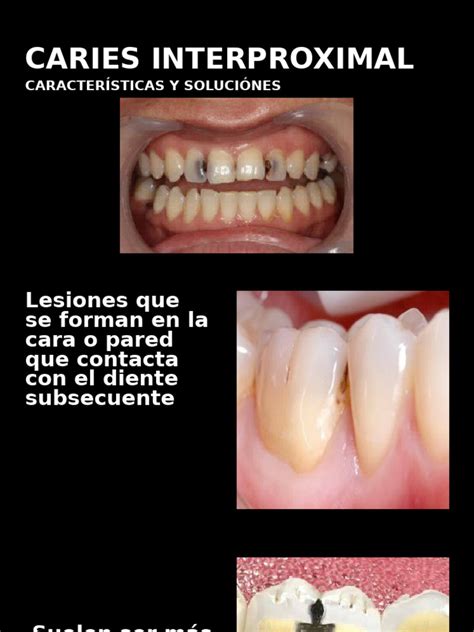 Caries Interproximal Pdf