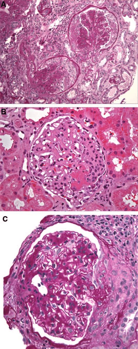 A Two Glomeruli Exhibit Nodular Diabetic Glomerulosclerosis And Download Scientific Diagram