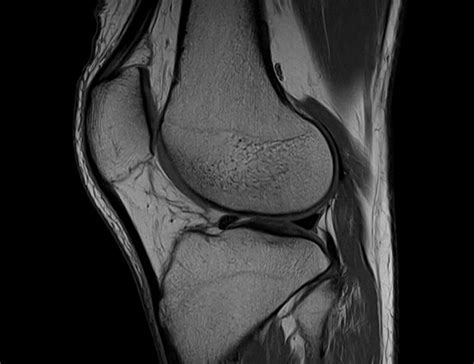 Proton Density Pd Weighted Mri Sequence Physics And Image Appearance