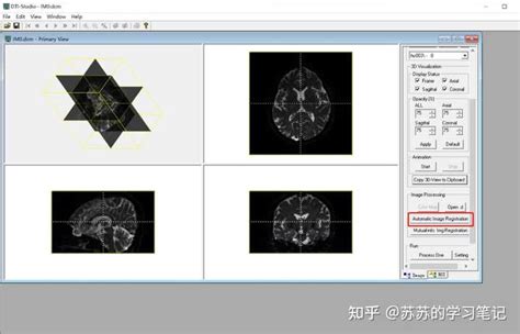 diffusion spectrum imaging dsi 扩散光谱成像 与 diffision tensor imaging （dti