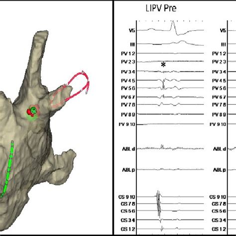 Left Panel Representative La Ensite Map After Re Pvi Only Ablation Download Scientific Diagram