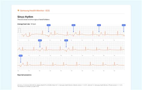 Premature Ventricular Contraction Trigeminy