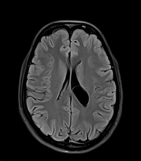Intraventricular Arachnoid Cysts Pacs