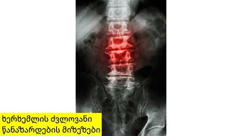 ხერხემლის ძვლოვანი წანაზარდების მიზეზები Youtube