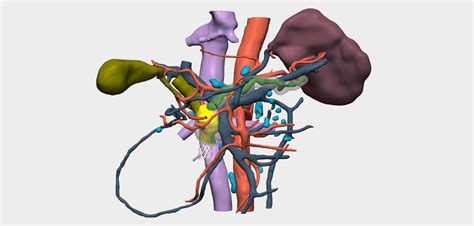 Adenocarcinoma De Cabeza De Páncreas Con Modelo 3d Cella Medical