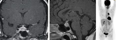 Pituitary Adenoma Diagnosis And Operative Considerations The