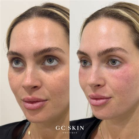PRP And PRF Treatments Gold Coast GC Skin Boutique