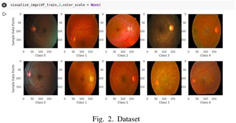 Figure 2 From Diabetic Retinopathy Detection Using A Hybrid Model Approach In Deep Learning