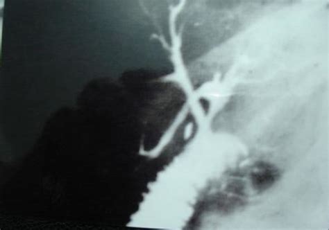 Transtubal Cholangiogram After Hepaticojejunostomy Roux En Y Download Scientific Diagram