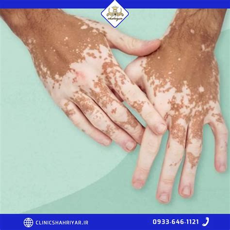 لک سفید پوستی چیست؟ دلیل ایجاد آن کلینیک زیبایی شهریار