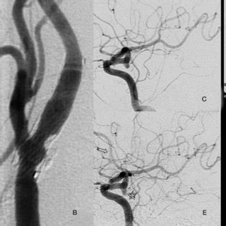 Case 1 A 45 Year Old Female With 98 Stenosis In The Left Internal Download Scientific Diagram