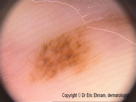 Dermoscopy Fibrillar Pattern